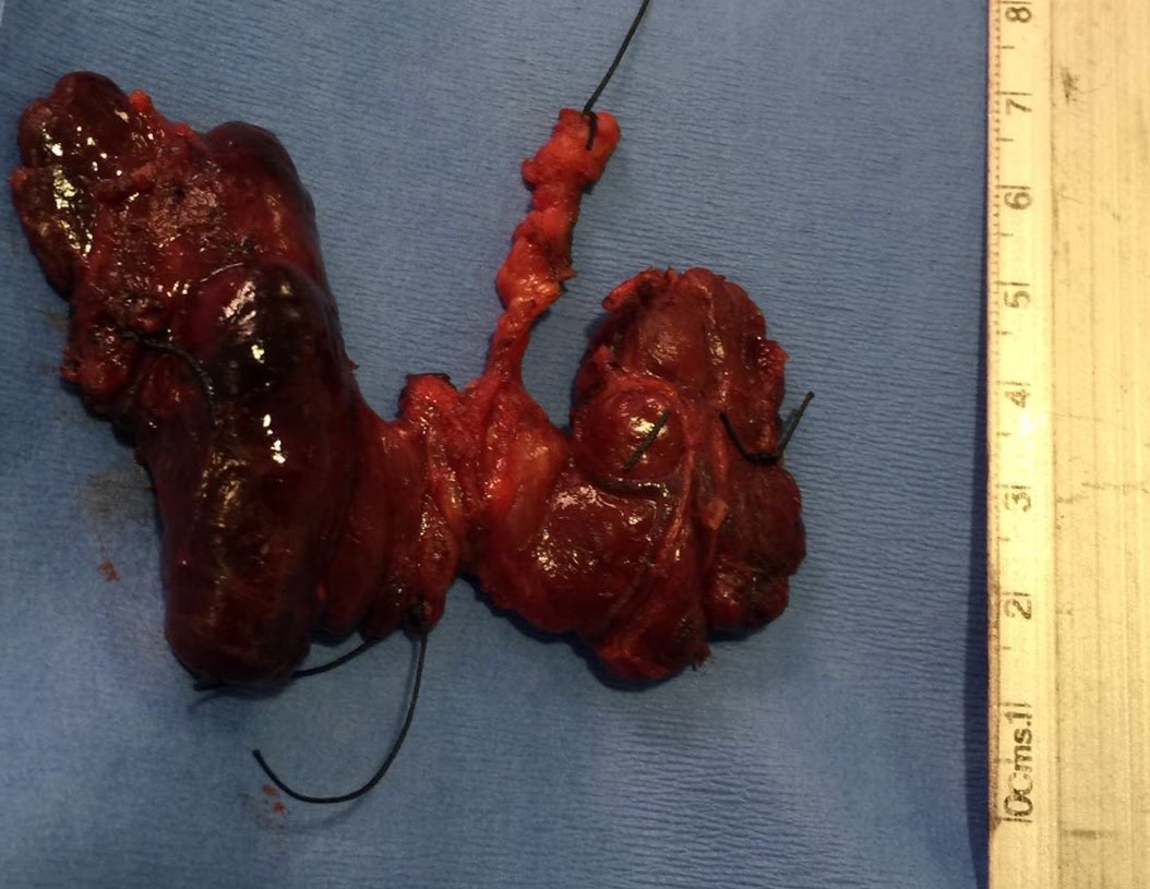 Thyroid Awareness Month – Follicular Thyroid Cancer (FTC) – Rodrigo ...