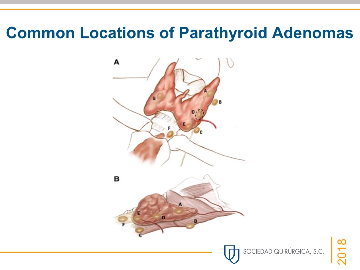 Localizaciones más Comunes de los Adenomas de Paratiroides en el ...