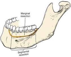 Segmental Mandibulectomy – Rodrigo Arrangoiz MS, MD, FACS, FSSO