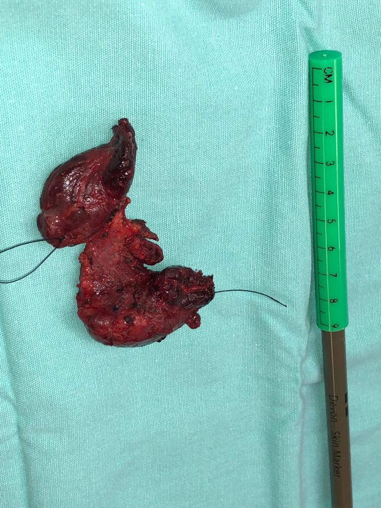 ¿Como se da el Seguimiento a Pacientes con Cáncer Medular de Tiroides ...