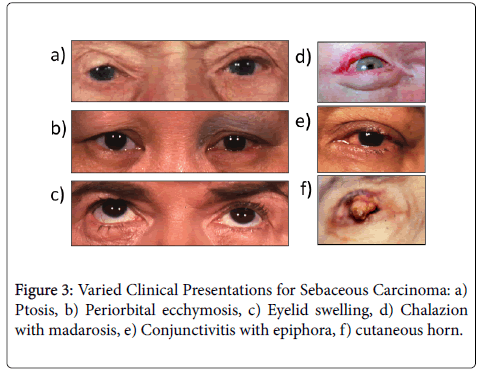 Sebaceous Gland Carcinoma – Rodrigo Arrangoiz MS, MD, FACS, FSSO