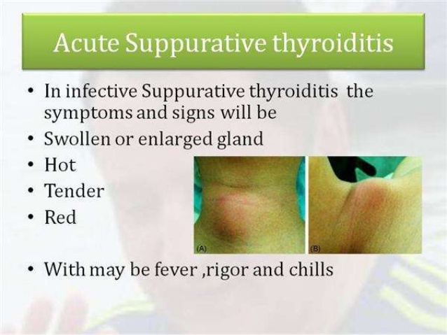 Acute Suppurative / Infectious Thyroiditis – Rodrigo Arrangoiz MS, MD ...
