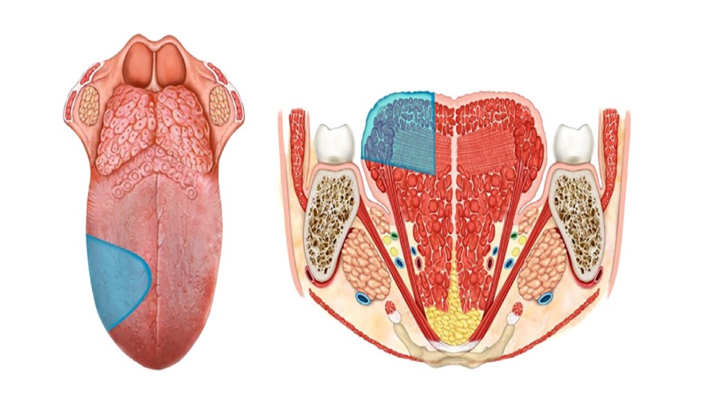 Classification of Glossectomies – Rodrigo Arrangoiz MS, MD, FACS, FSSO