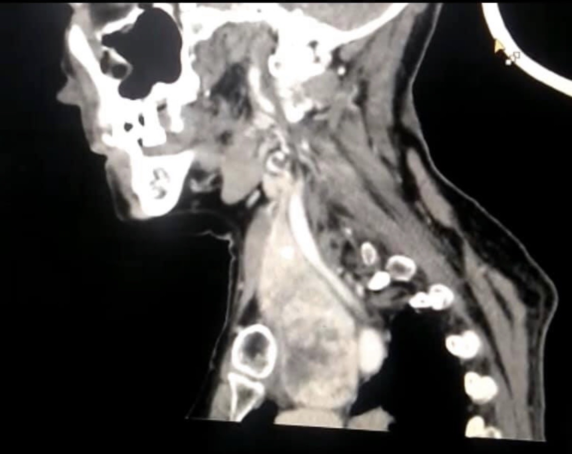 CT Scanning is Indicated for Retrosternal Goiter – Rodrigo Arrangoiz MS ...