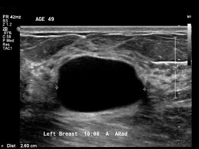 Simple Breast Cyst – Rodrigo Arrangoiz MS, MD, FACS, FSSO