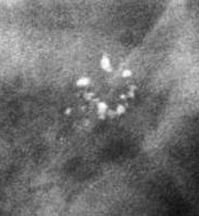 Types of Calcifications of the Breast – Rodrigo Arrangoiz MS, MD, FACS ...