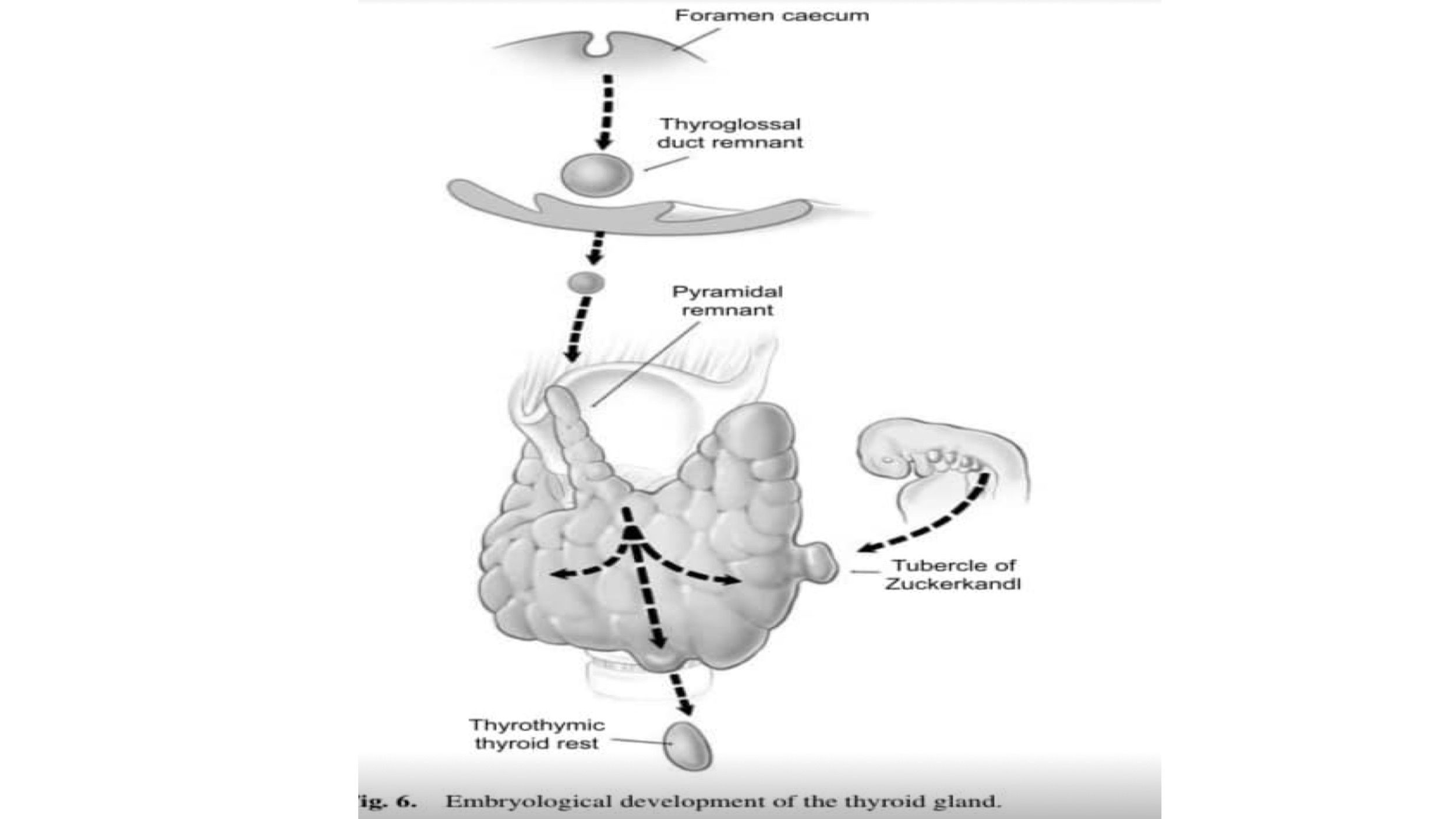 Total Thyroidectomy – Ensuring Completeness of Resection – Rodrigo ...