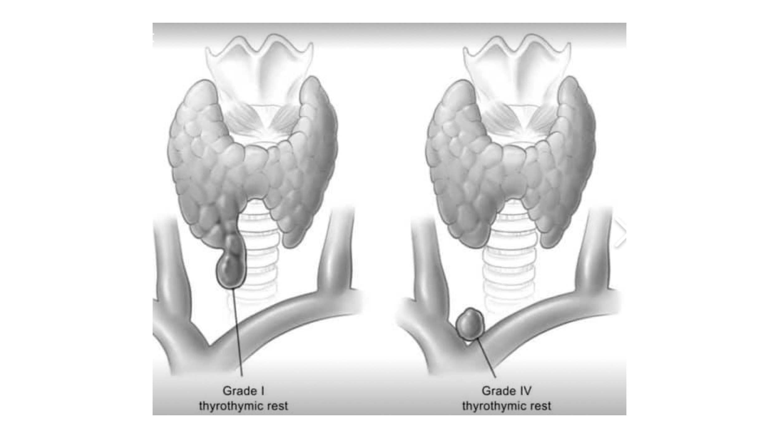 Total Thyroidectomy – Ensuring Completeness of Resection – Rodrigo ...
