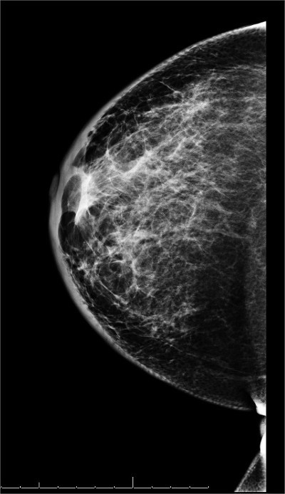 Breast Mammogram – Rodrigo Arrangoiz MS, MD, FACS, FSSO