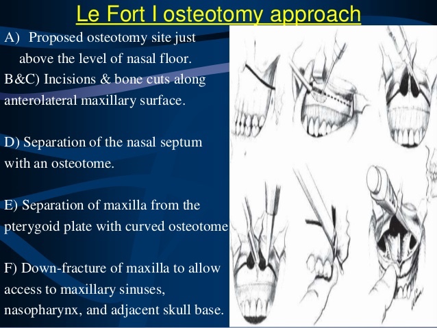 Surgical Approaches to the Nasopharynx – Rodrigo Arrangoiz MS, MD, FACS ...