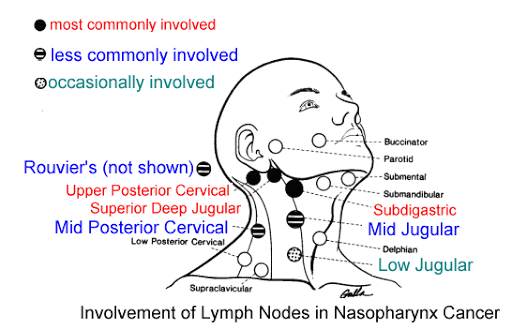 Nasopharyngeal Carcinoma (NPC) – Rodrigo Arrangoiz MS, MD, FACS, FSSO