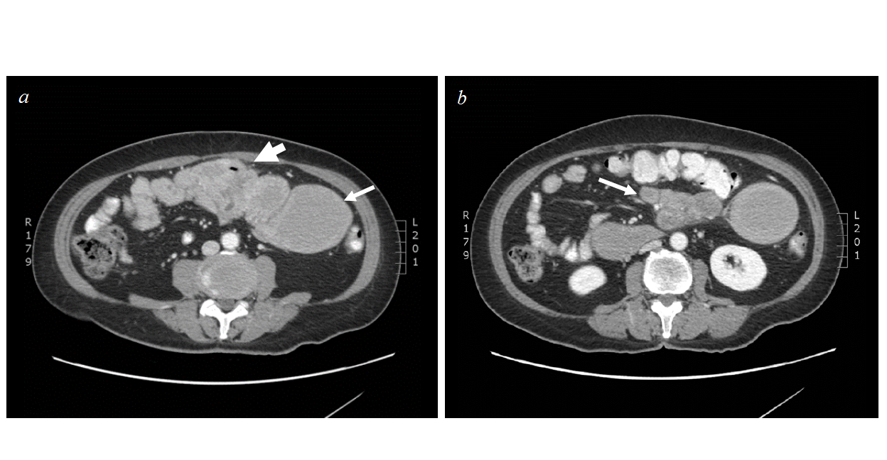 Diagnostic Work-Up of Small Bowel Adenocarcinoma – Rodrigo Arrangoiz MS ...