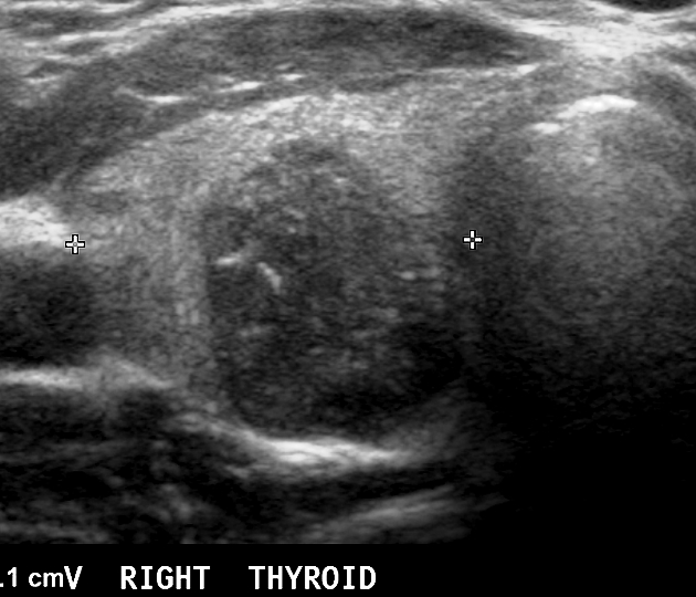 The Usefulness of Contrast-Enhanced Ultrasound to Evaluate Small Solid ...