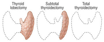Total Thyroidectomy – Ensuring Completeness of Resection – Rodrigo ...