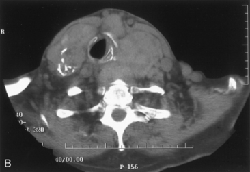 Substernal Goiter: Type II Posterior Mediastinal Goiters – Rodrigo ...