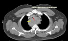 Isolated Mediastinal Goiter (Substernal Goiter Type III) – Rodrigo ...