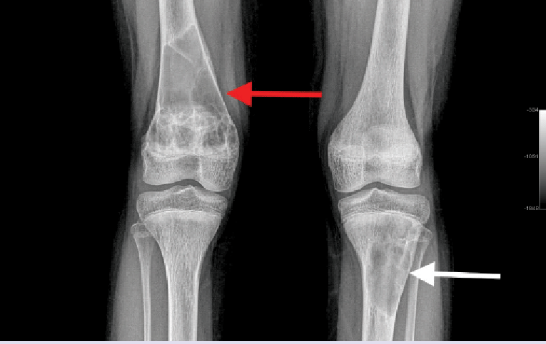 Bone Disease and Primary Hyperparathyroidism – Rodrigo Arrangoiz MS, MD ...