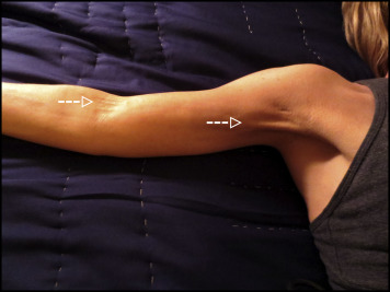 Axillary Web Syndrome – Rodrigo Arrangoiz MS, MD, FACS, FSSO