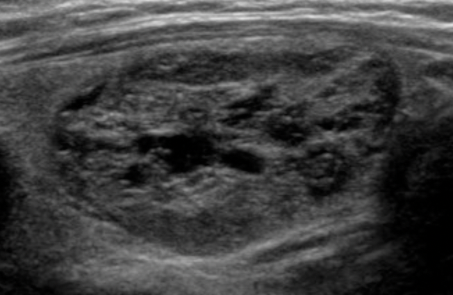 ACR Thyroid Imaging, Reporting and Data System – Rodrigo Arrangoiz MS ...