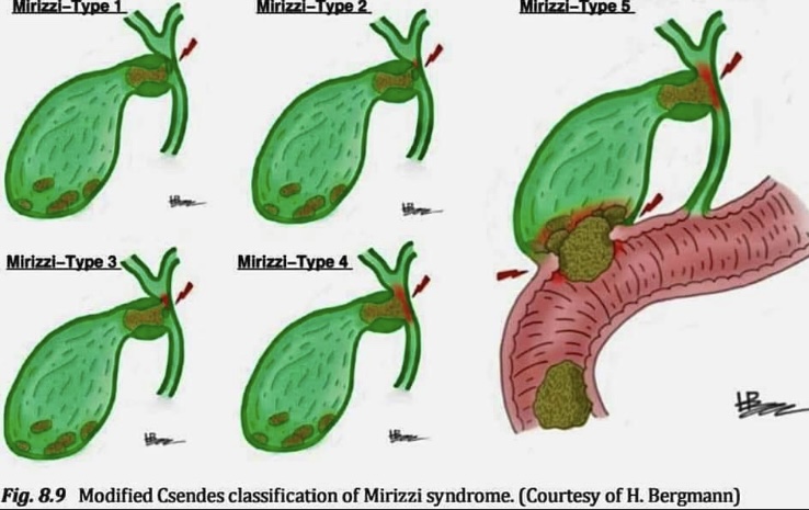 Modified 𝘾𝙨𝙚𝙣𝙙𝙚𝙨 classification of 𝙈𝙞𝙧𝙧𝙞𝙯𝙞 syndrome – Rodrigo Arrangoiz ...