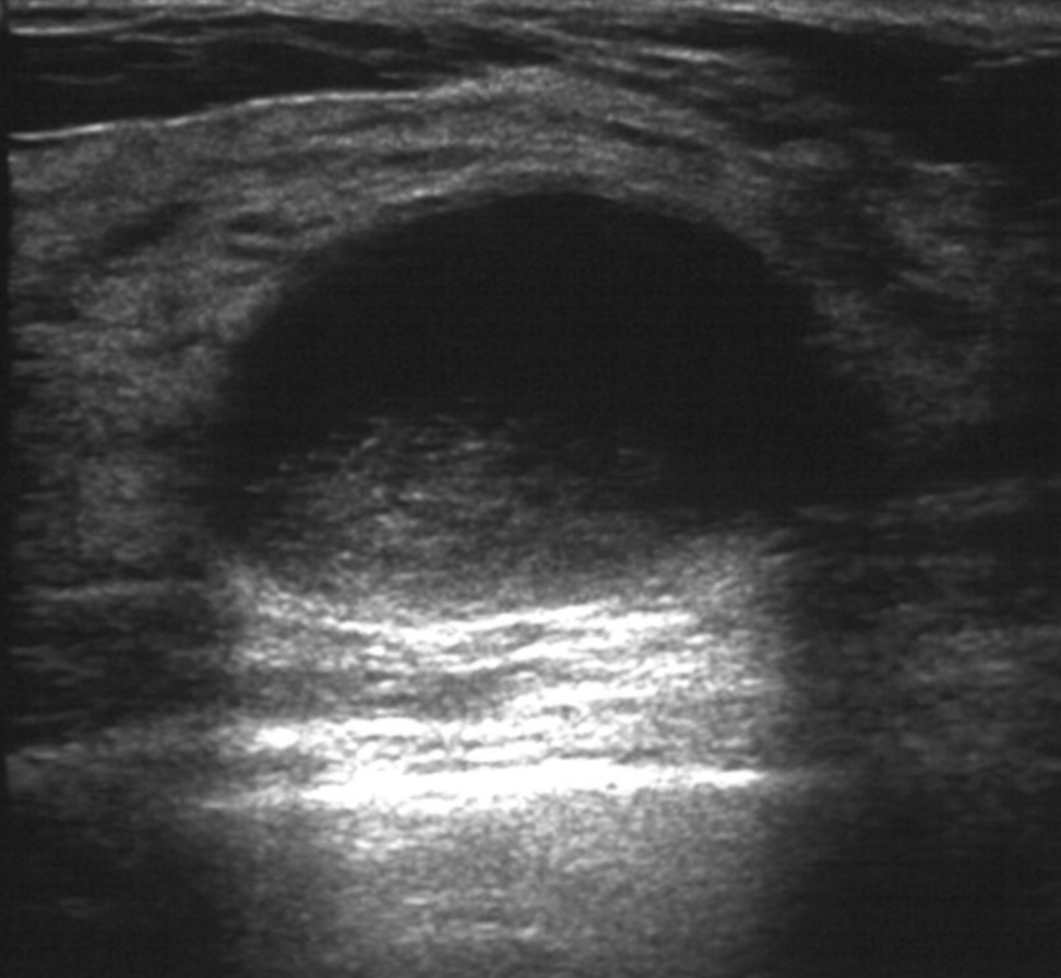 Complicated Cysts – Rodrigo Arrangoiz MS, MD, FACS, FSSO
