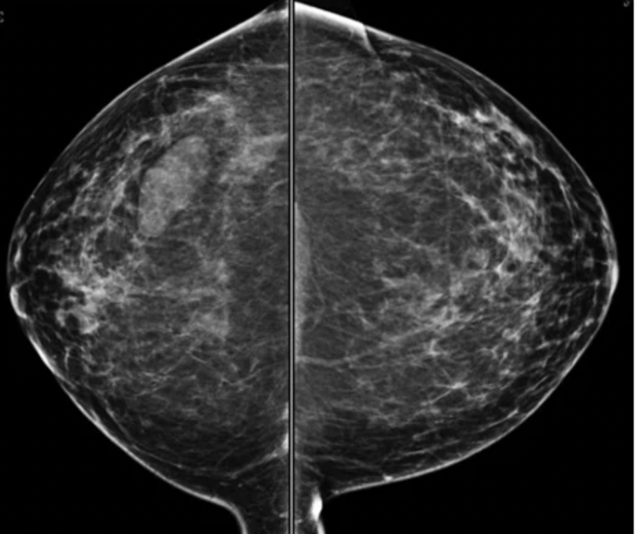 Pseudoangiomatous Stromal Hyperplasia (PASH) – Rodrigo Arrangoiz MS, MD ...