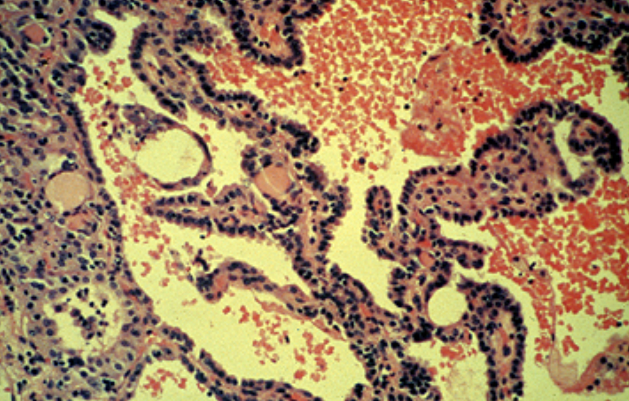 Classic Papillary Thyroid Cancer (PTC) – Rodrigo Arrangoiz MS, MD, FACS ...