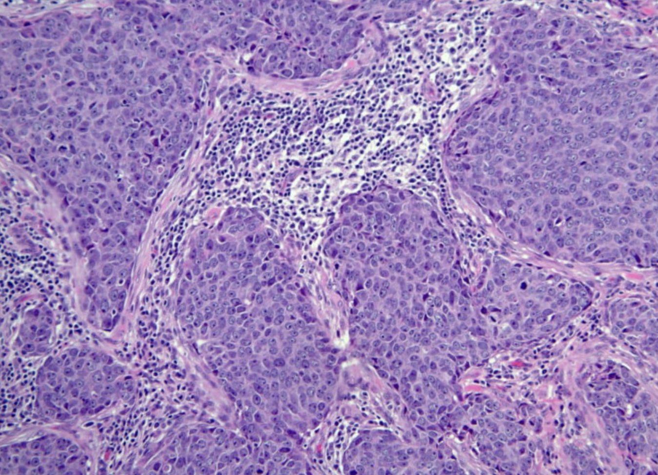 Etiology and Pathogenesis of Triple Negative Breast Cancer – Rodrigo ...