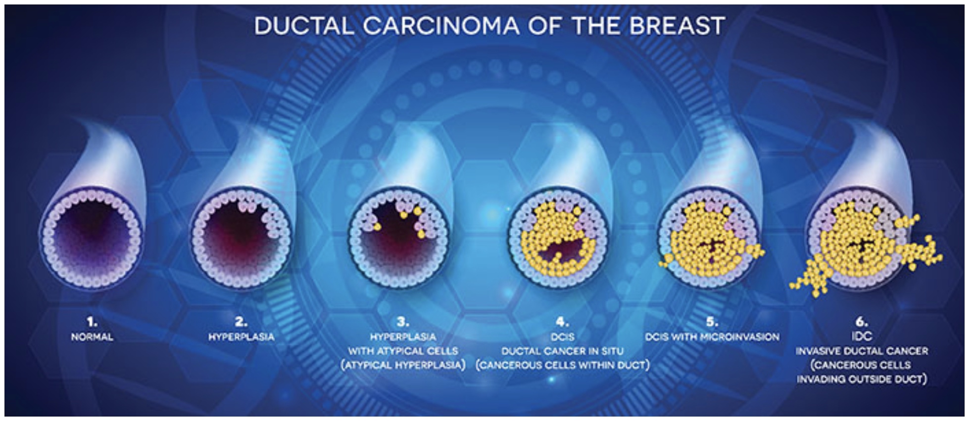 Definition of Ductal Carcinoma In Situ (DCIS) and Lobular Carcinoma In ...