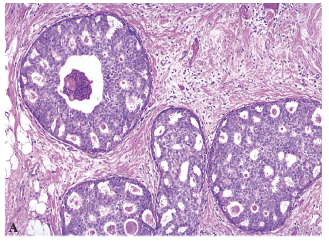 Pathology of Ductal Carcinoma In Situ (DCIS) – Rodrigo Arrangoiz MS, MD ...