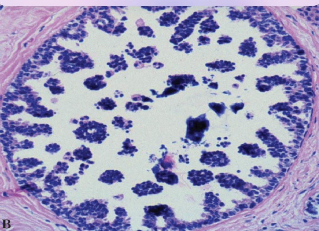 Pathology of Ductal Carcinoma In Situ (DCIS) – Rodrigo Arrangoiz MS, MD ...