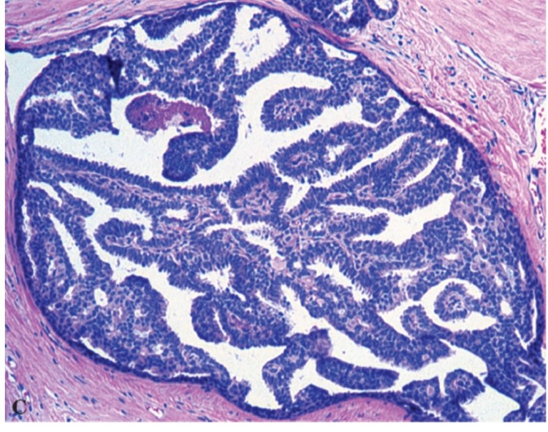 Pathology of Ductal Carcinoma In Situ (DCIS) – Rodrigo Arrangoiz MS, MD ...