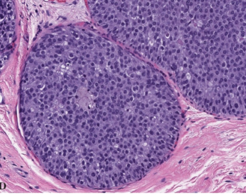 Pathology of Ductal Carcinoma In Situ (DCIS) – Rodrigo Arrangoiz MS, MD ...
