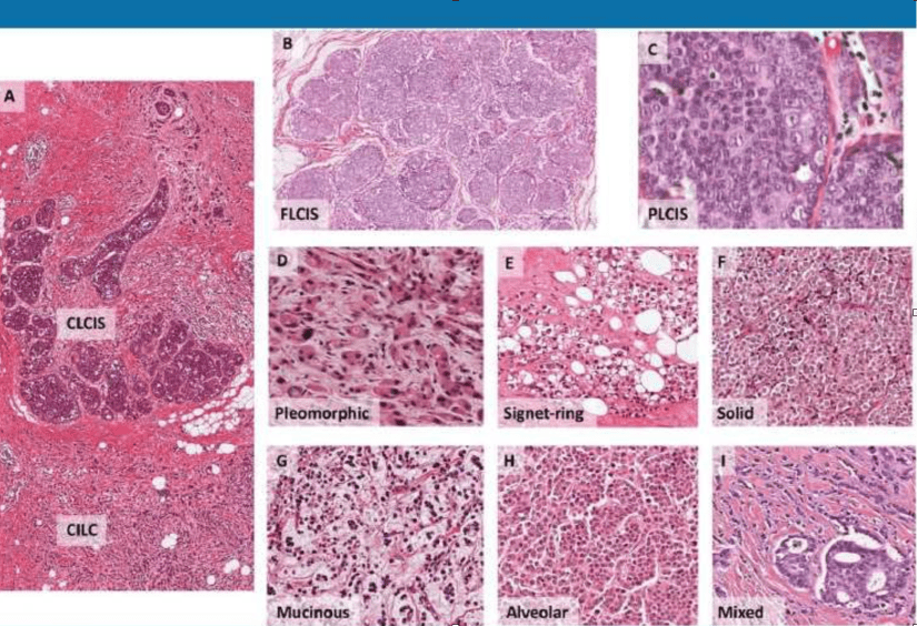 Invasive Lobular Carcinoma of the Breast – Rodrigo Arrangoiz MS, MD ...
