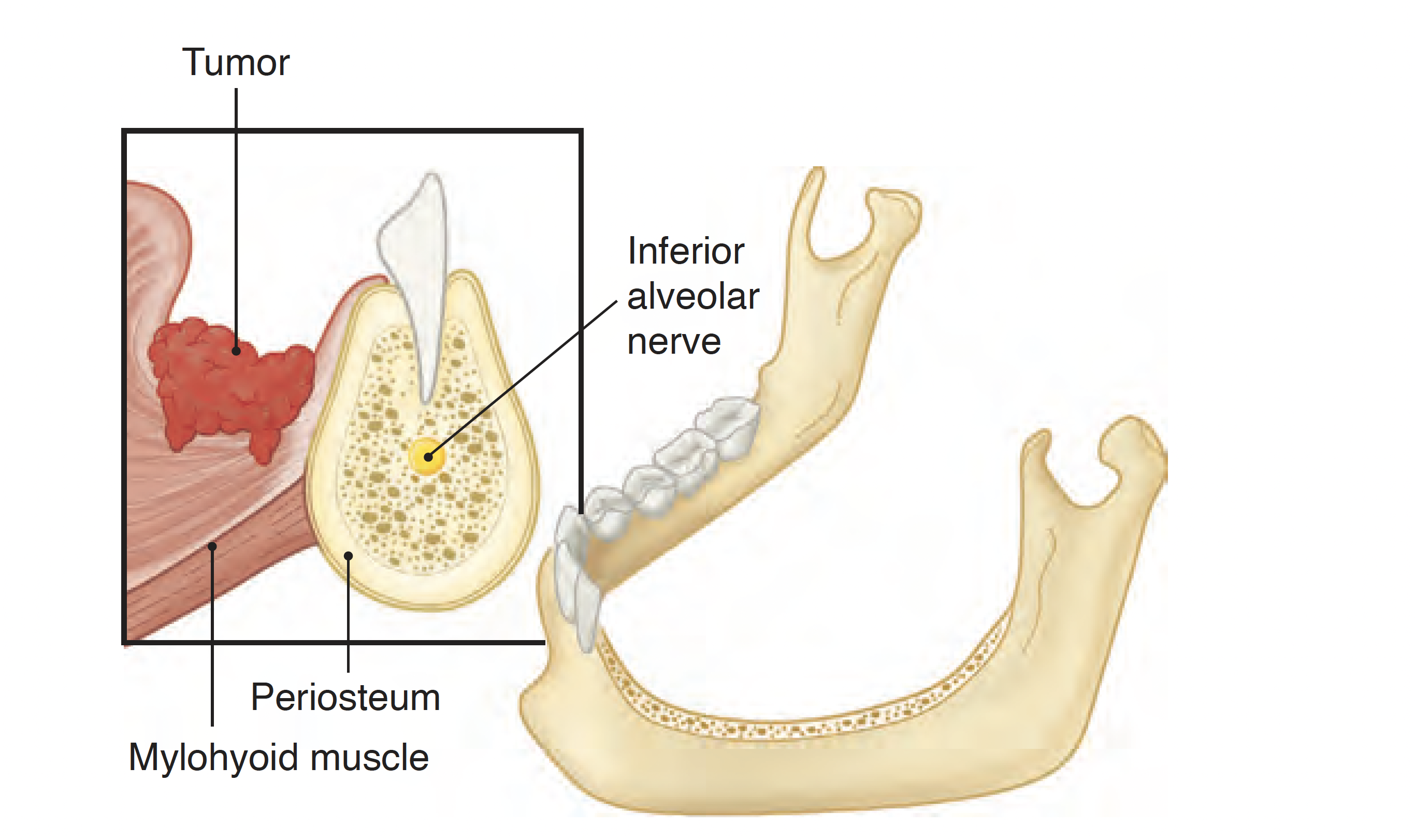 Pathway by Which Oral Cancers Invade the Mandible – Rodrigo Arrangoiz ...