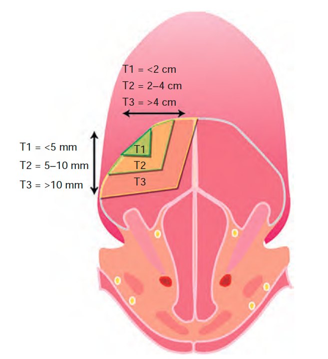 Depth of Invasion in Oral Cavity Cancer – Rodrigo Arrangoiz MS, MD ...