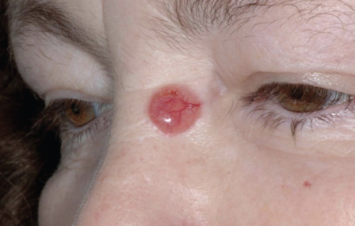 Pathology of Basal Cell Carcinomas (BCC) – Rodrigo Arrangoiz MS, MD ...