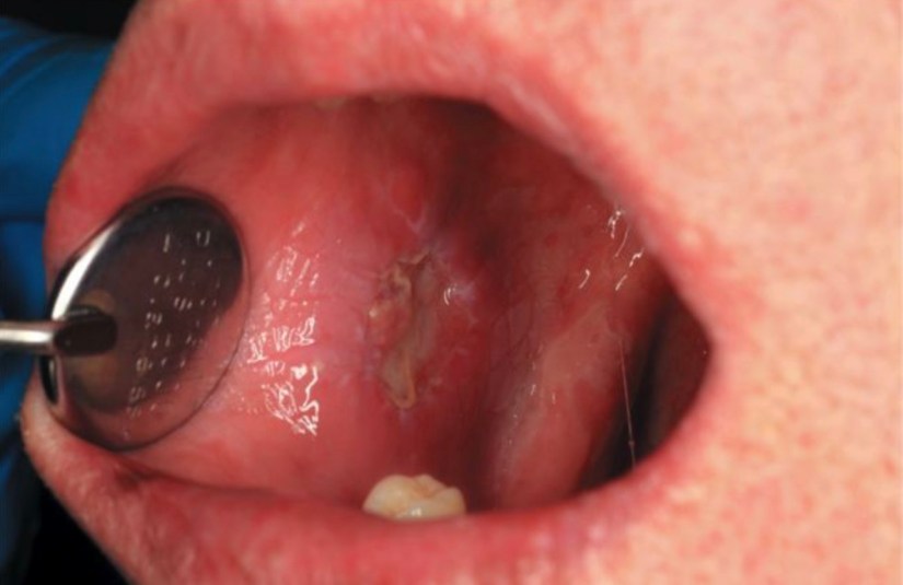 Buccal Carcinoma of the Head and Neck – Rodrigo Arrangoiz MS, MD, FACS ...