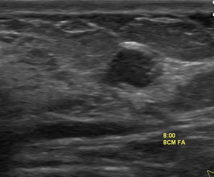 Ultrasound Evaluation of Breast Nodules – Rodrigo Arrangoiz MS, MD ...