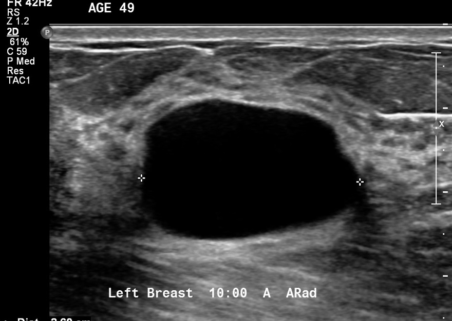 Simple Breast Cyst – Rodrigo Arrangoiz MS, MD, FACS, FSSO