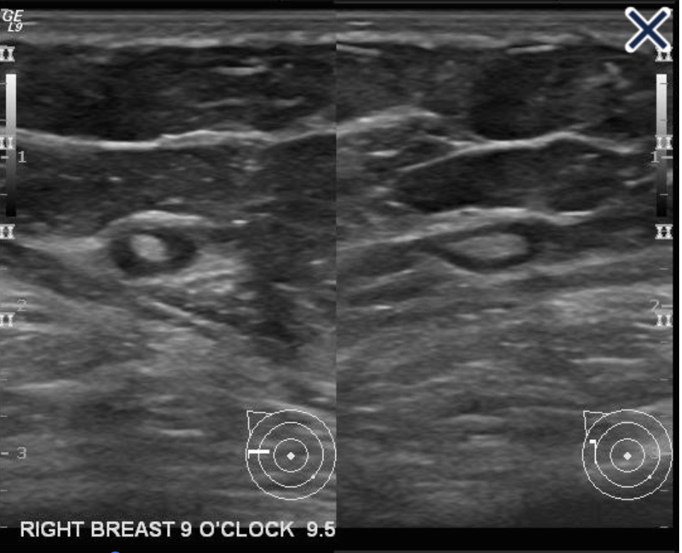 Ultrasound Characteristics of Axillary Lymph Nodes – Rodrigo Arrangoiz ...