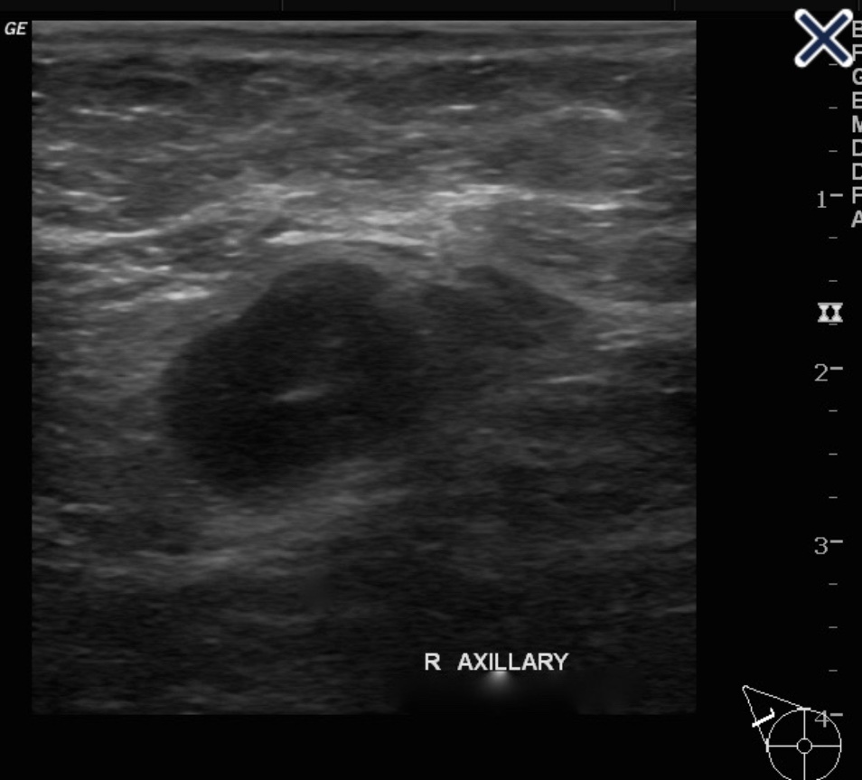 Ultrasound Characteristics of Axillary Lymph Nodes – Rodrigo Arrangoiz ...