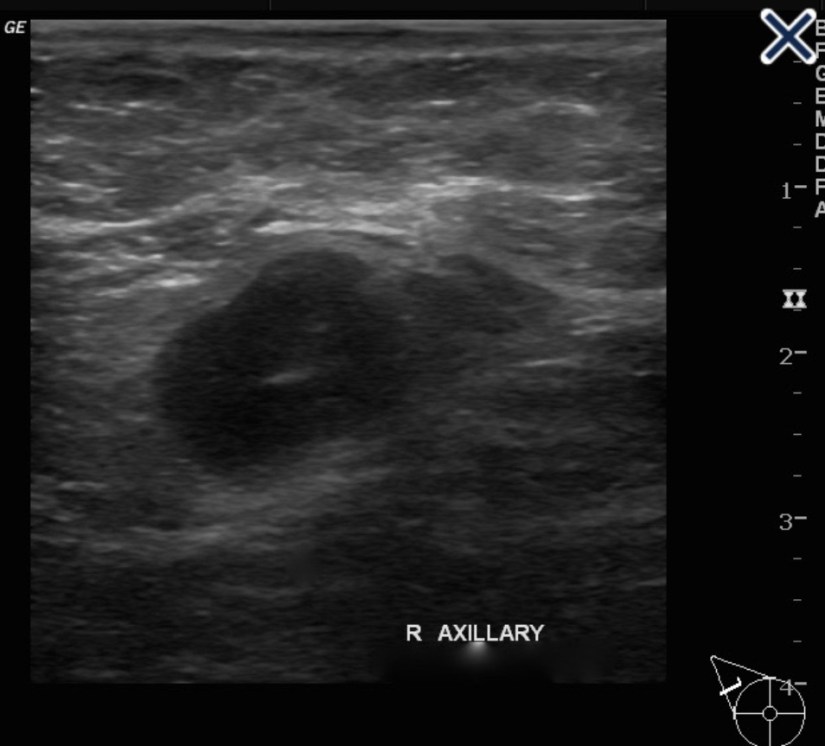 Ultrasound Characteristics of Axillary Lymph Nodes – Rodrigo Arrangoiz ...