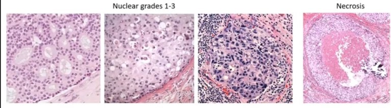 Ductal Carcinoma In Situ (DCIS) /Intraductal Carcinoma Pathology 1 ...