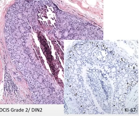 Ductal Carcinoma In Situ (DCIS) Pathology 2 – Rodrigo Arrangoiz MS, MD ...