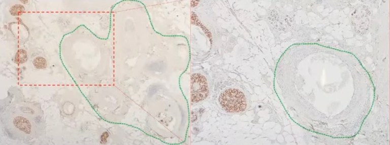 DCIS: Implications of ER, PR, and HER2 Expression – Rodrigo Arrangoiz ...