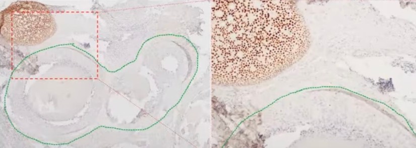 DCIS: Implications of ER, PR, and HER2 Expression – Rodrigo Arrangoiz ...