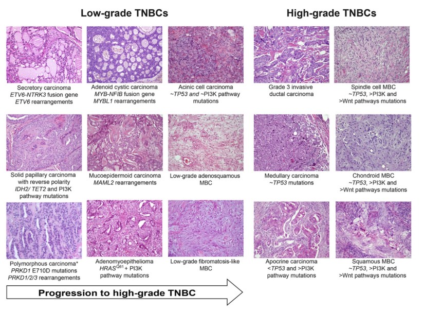 Pathology of Triple Negative Breast Cancer Part 1 – Rodrigo Arrangoiz ...