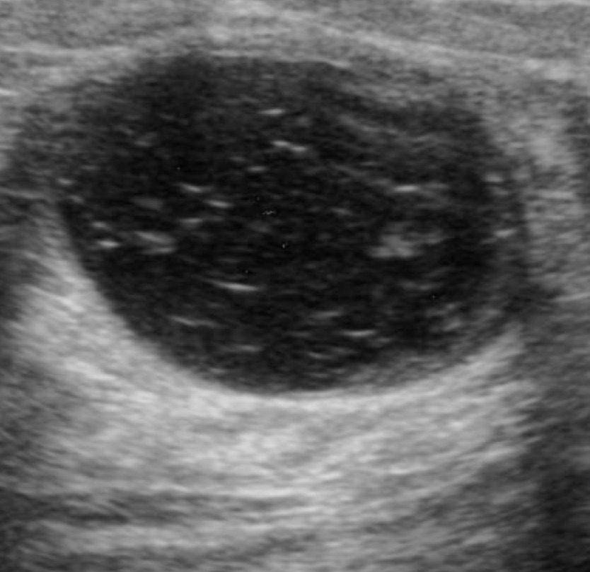 The Ten Signs of Malignancy on Ultrasound of the Breast – Rodrigo ...