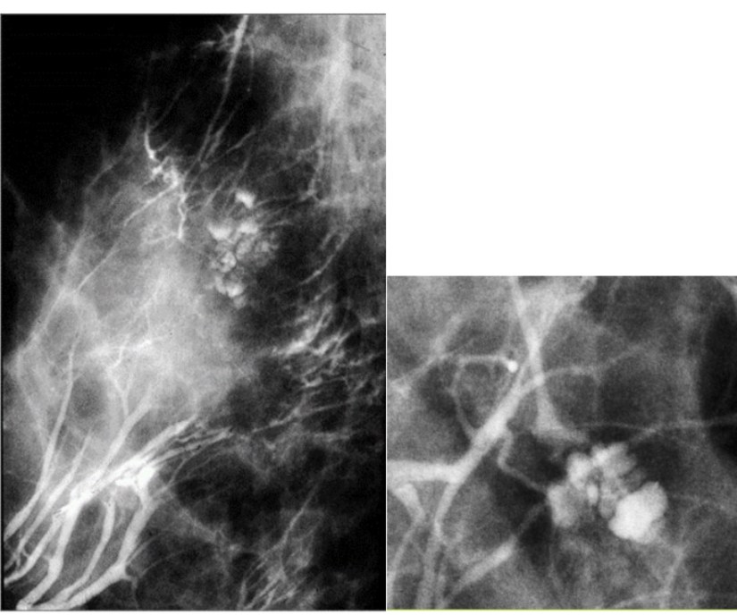 Calcifications Identified on Mammogram – Rodrigo Arrangoiz MS, MD, FACS ...